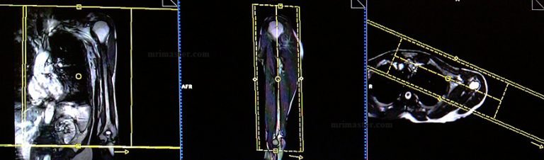 magnetic resonance angiography(MRA) upper arm protocols and planning ...