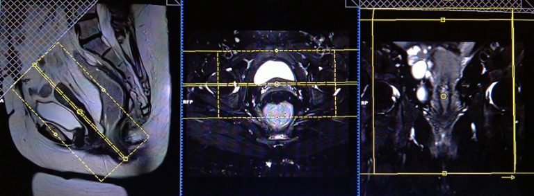 MRI female pelvis planning for different types of endometrial cancers