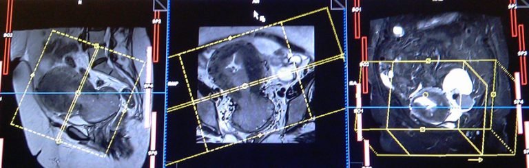 mri female pelvis planning for different types of cervix cancers