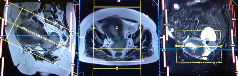 mri female pelvis planning for different types of cervix cancers