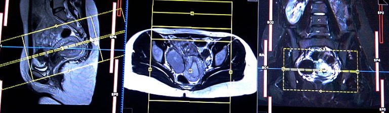 MRI female pelvis planning for different types of endometrial cancers
