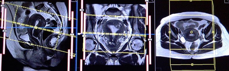 MRI female pelvis planning for different types of endometrial cancers
