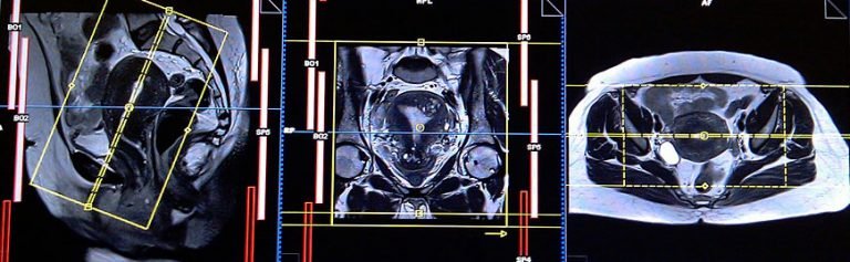 MRI female pelvis planning for different types of endometrial cancers