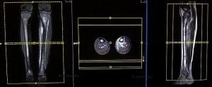 Lower Leg (Tibia and Fibula) MRI Protocols and Planning | Indications ...