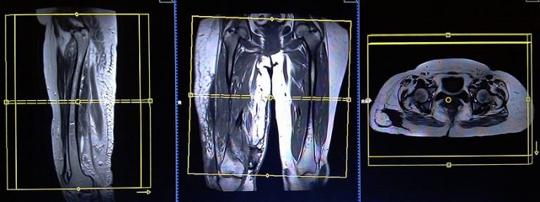 MRI Thigh (Upper Legs) Planning | MRI Hamstring Protocols |Indications ...