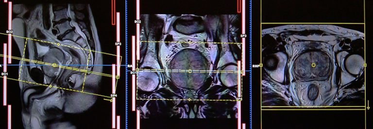 PLAN PROSTATE variations in planning - mrimaster