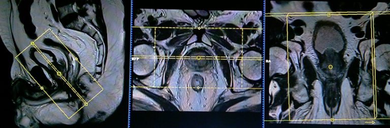 PLAN PROSTATE variations in planning - mrimaster