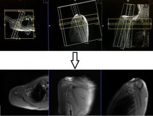 MRI scapula protocols, planning, positioning and indications