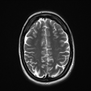 MRI brain axial T2 images - mrimaster