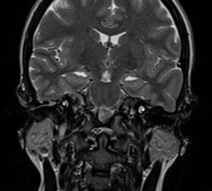 MRI T2 coronal images of IAM'S