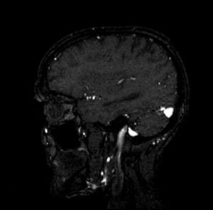PLAN MRV BRAIN IMAGE TOF 2D. - mrimaster