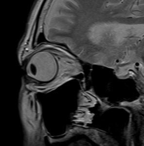 MRI Orbits sagittal T2 right orbit images - mrimaster
