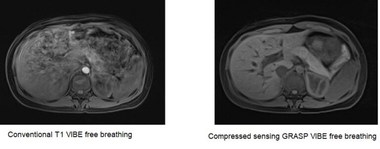MRI Artifacts | MRI Motion artifact | Ghosting artifact mri