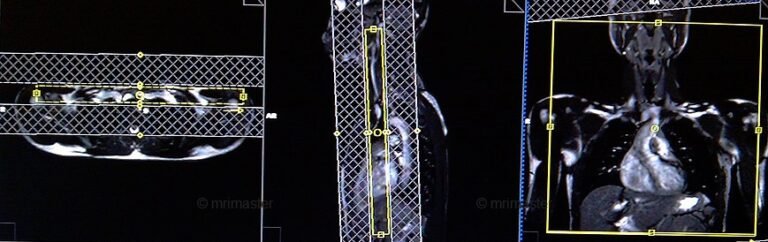 magnetic resonance angiography(MRA) whole body protocols and planning ...