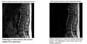 MRI Artifacts | MRI Motion artifact | Ghosting artifact mri