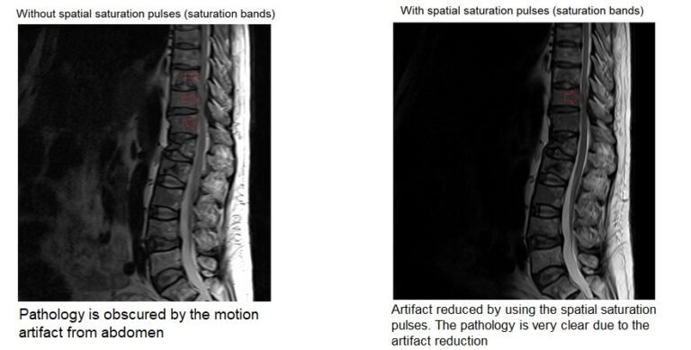 MRI Artifacts | MRI Motion artifact | Ghosting artifact mri