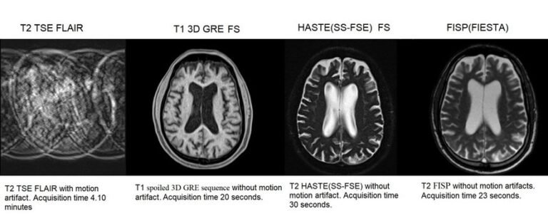 MRI Artifacts | MRI Motion artifact | Ghosting artifact mri
