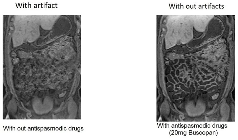 MRI Artifacts | MRI Motion artifact | Ghosting artifact mri