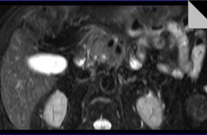 PLAN SECRETIN MRCP t2 tse fs - mrimaster