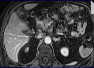 PLAN PANCREAS T1 DYNAMIC AXIAL VEINOUS - mrimaster