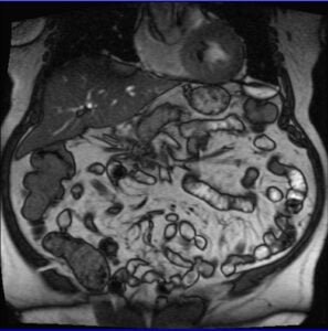 PLAN SECRETIN MRCP trufi - mrimaster