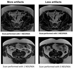 MRI Artifacts | MRI Motion artifact | Ghosting artifact mri