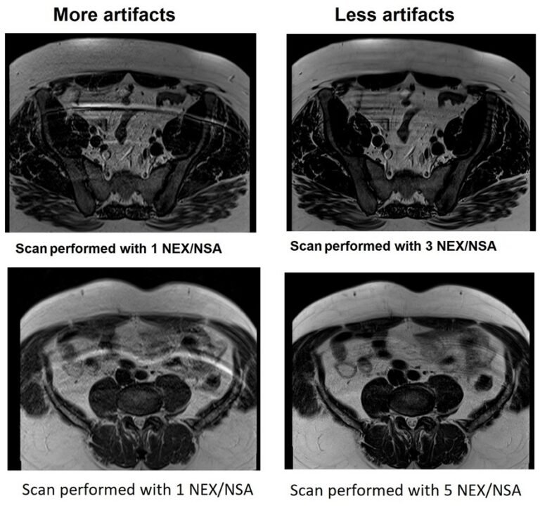 MRI Artifacts | MRI Motion artifact | Ghosting artifact mri