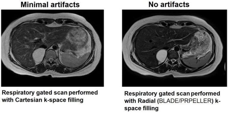 MRI Artifacts | MRI Motion artifact | Ghosting artifact mri