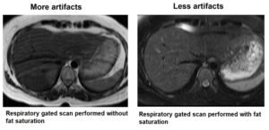 MRI Artifacts | MRI Motion artifact | Ghosting artifact mri
