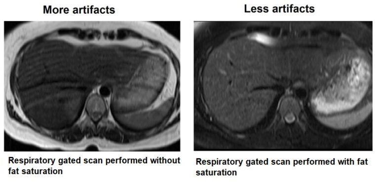MRI Artifacts | MRI Motion artifact | Ghosting artifact mri