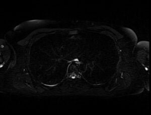MRI chest axial T2 STIR images
