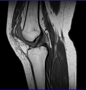 PLAN KNEE t1 sagittal - mrimaster