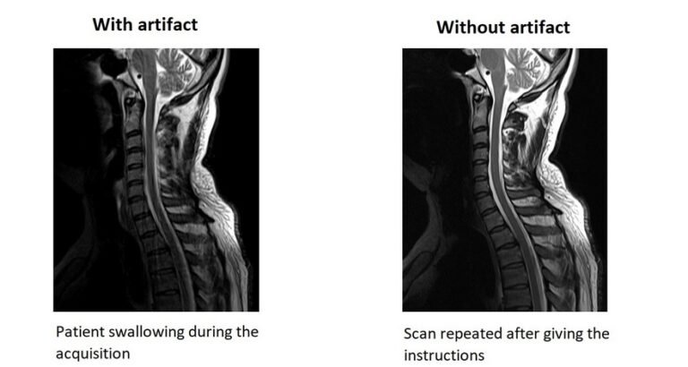 Mri Artifacts Mri Motion Artifact Ghosting Artifact Mri