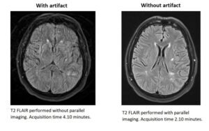MRI Artifacts | MRI Motion artifact | Ghosting artifact mri