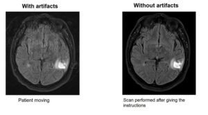 MRI Artifacts | MRI Motion artifact | Ghosting artifact mri