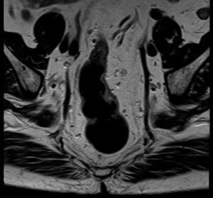 PLAN RECTAL CA PELVIS t2 coronal oblique high res - mrimaster