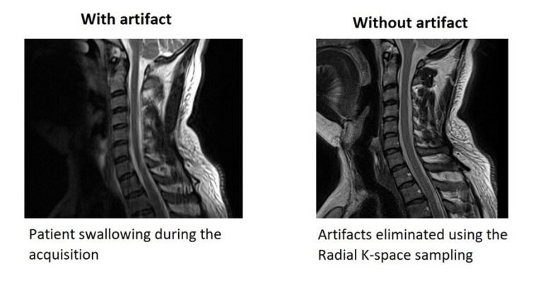 MRI Artifacts | MRI Motion artifact | Ghosting artifact mri