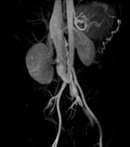 PLAN MRV ABD CORONAL FLASH POST MIP - mrimaster