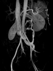PLAN MRV ABD CORONAL FLASH POST MIP - mrimaster