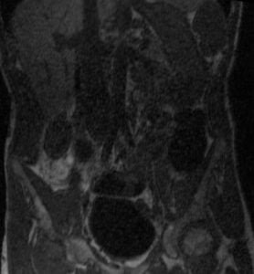 PLAN MRV ABD CORONAL FLASH PRE - mrimaster