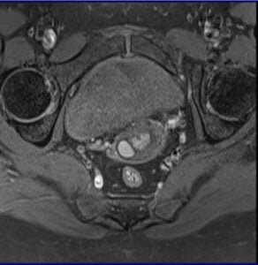 MRI endometrial cancers T1 FS axial images