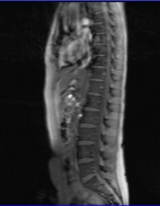 PLAN spinal cord loc lower - mrimaster