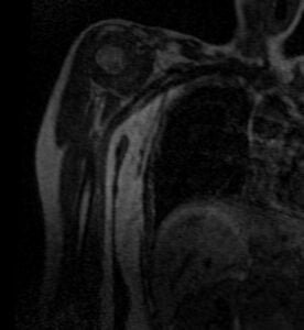 PLAN MRA UPPER ARM flash 3d pre - mrimaster