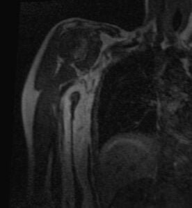 PLAN MRA UPPER ARM flash 3d pre - mrimaster