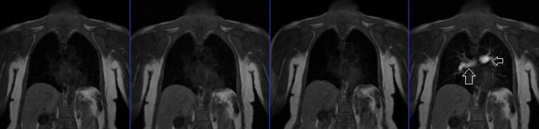 magnetic resonance angiography(MRA) whole body protocols and planning ...