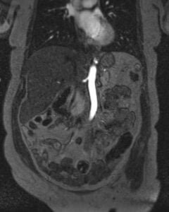 PLAN MRV ABD CORONAL FLASH POST - mrimaster