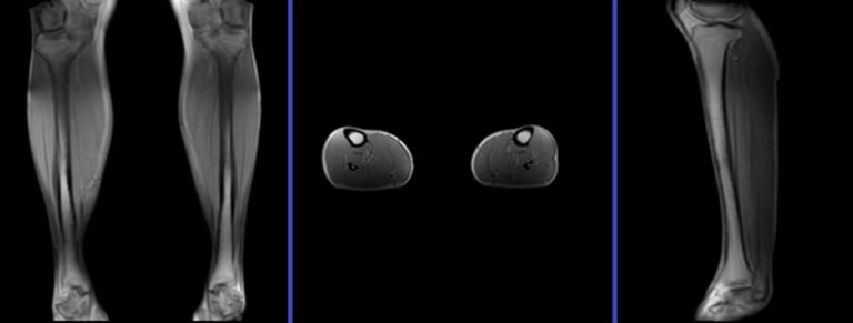 magnetic resonance angiography(MRA) whole body protocols and planning ...