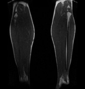 PLAN MRA W BODY FLASH LOWER LEG PRE - mrimaster