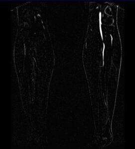 PLAN MRA W BODY FLASH LOWER LEG POST sub - mrimaster