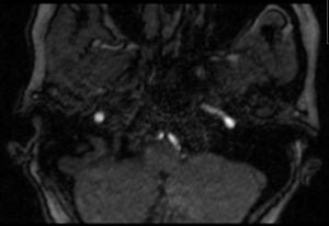 Neck MRA TOF axial images